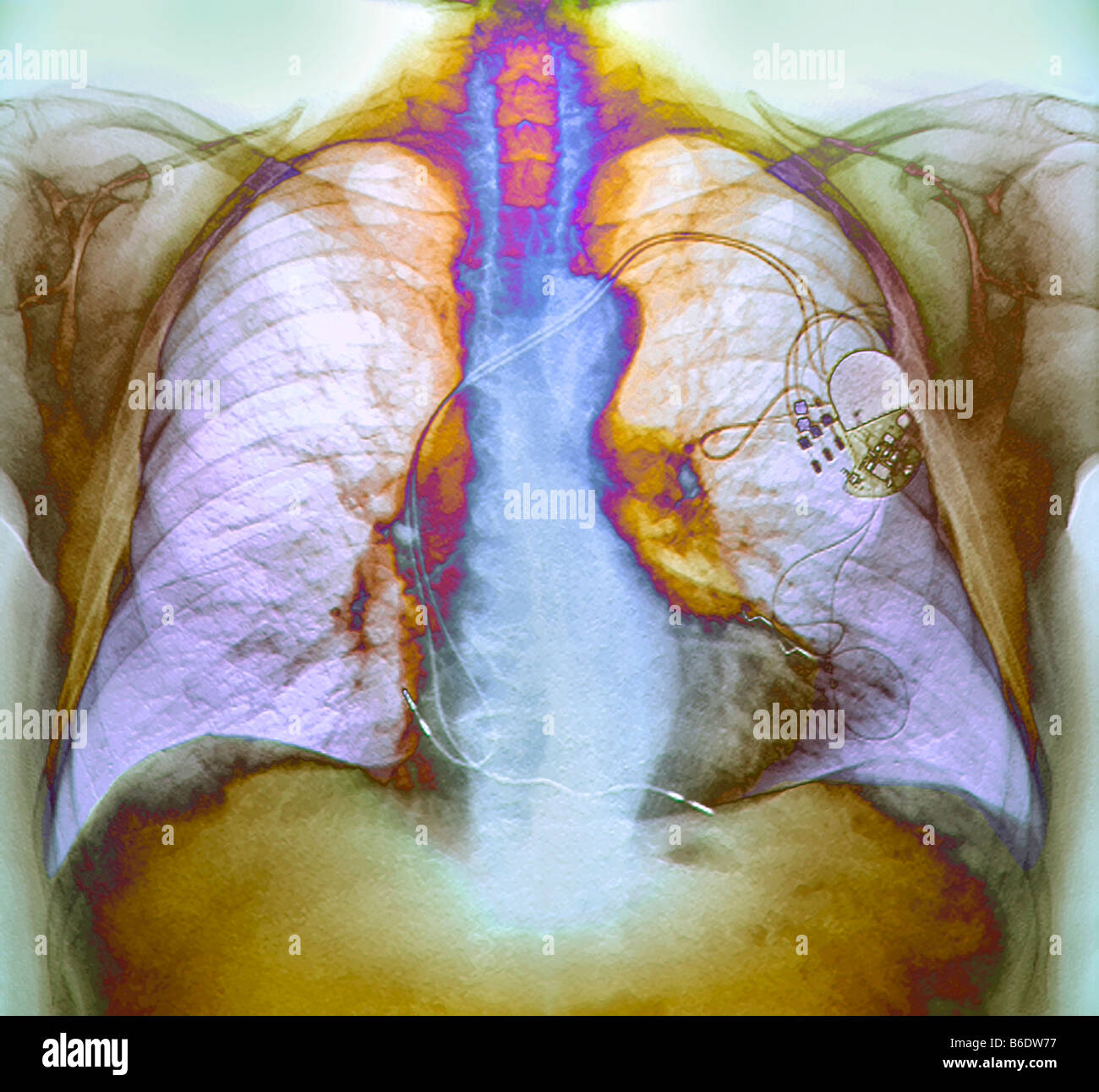 Heart Pacemaker Coloured Frontal X Ray Of The Chest Of A 64 Year Old Patient With A