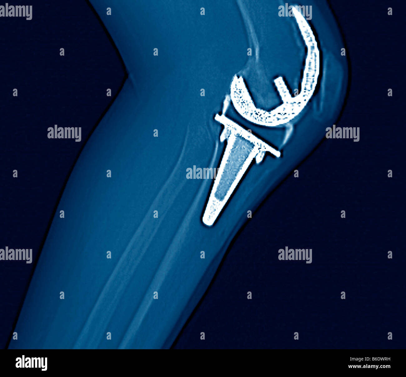 Artificial knee coloured computed tomography hi-res stock photography ...