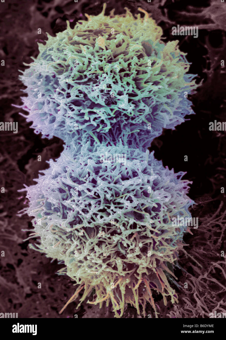 Cervical cancer cell. Coloured scanning electron micrograph (SEM) of a ... Cervical cancer cell. Coloured scanning electron micrograph (SEM) of a ...