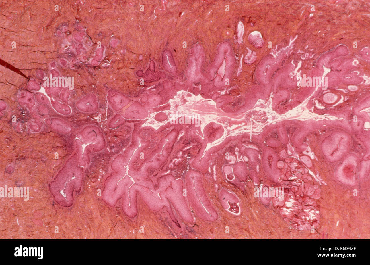 Cervical cancer. Light micrograph of a section through a cervix showing ...
