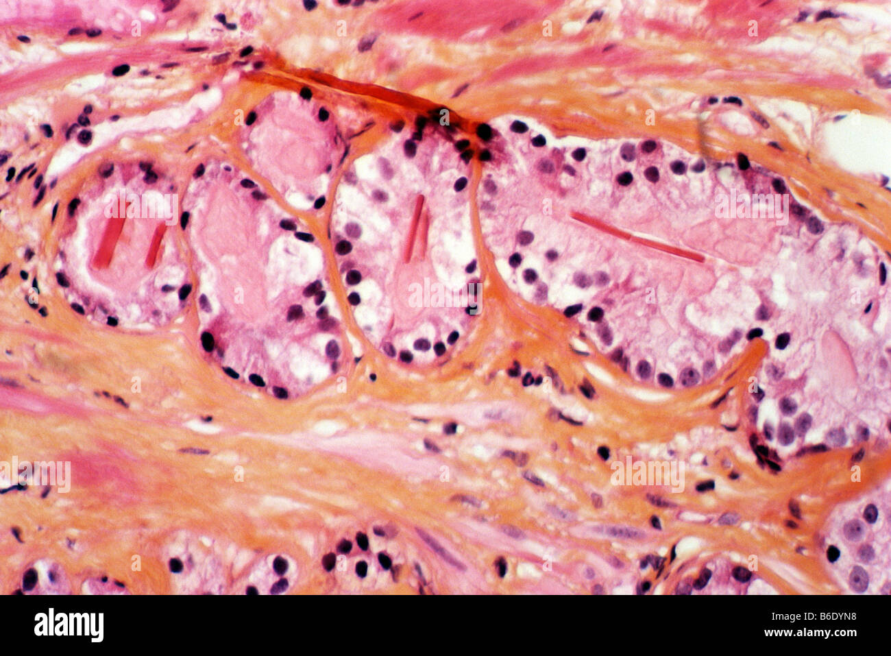 Prostate cancer. Light micrograph of a section through prostate tissue ...