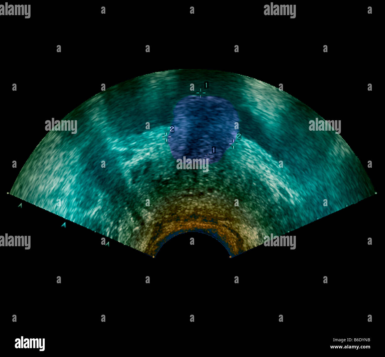 Prostate tumour. Coloured ultrasound scan of a section through the ...