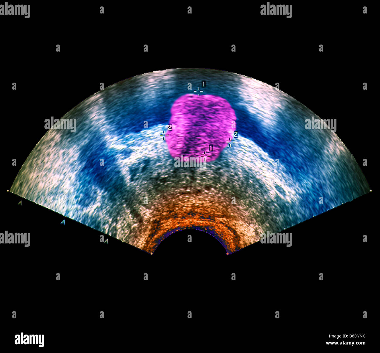 Prostate tumour. Coloured ultrasound scan of a section through the ...