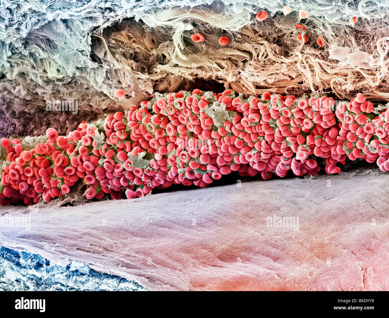Blood clot, Coloured scanning electron micrograph (SEM) of blood Stock ...