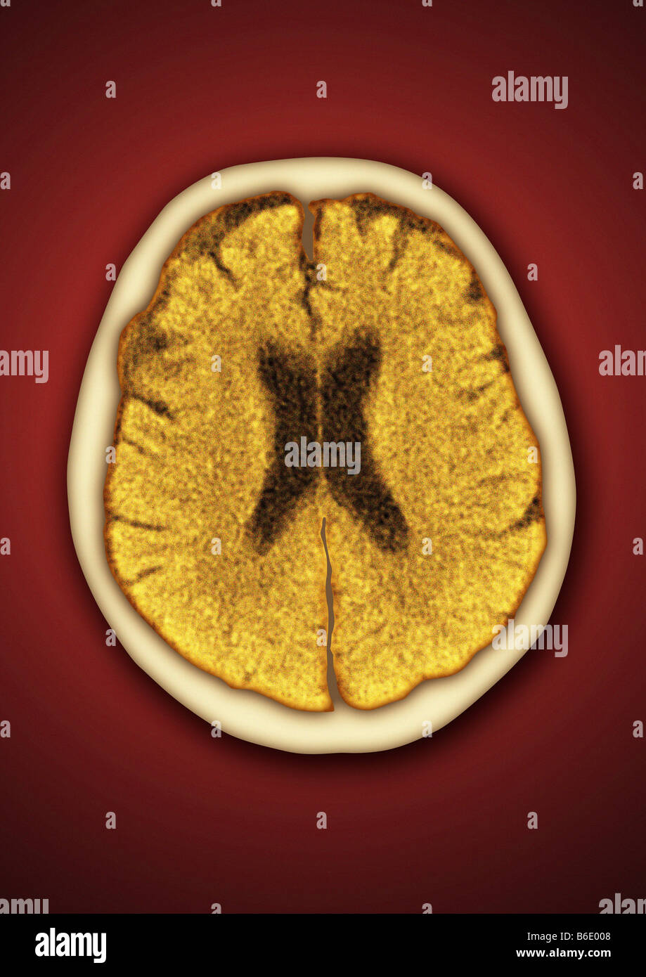 Healthy brain. Coloured computed tomography(CT) scan of a human head Stock Photo - Alamy