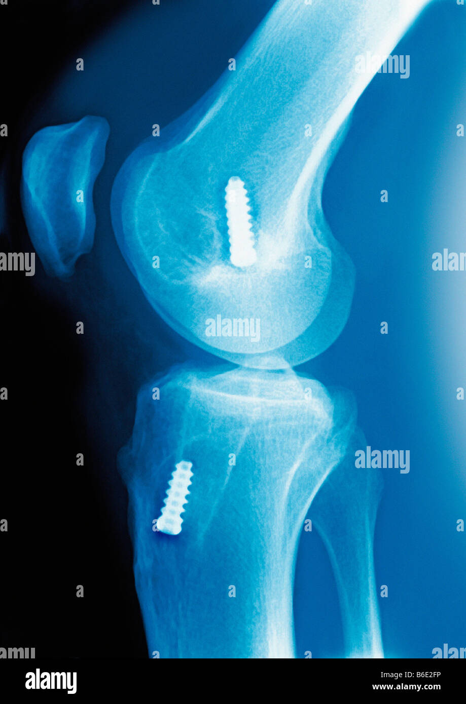 Anterior cruciate ligament repair. Coloured profile X-ray of fixation ...