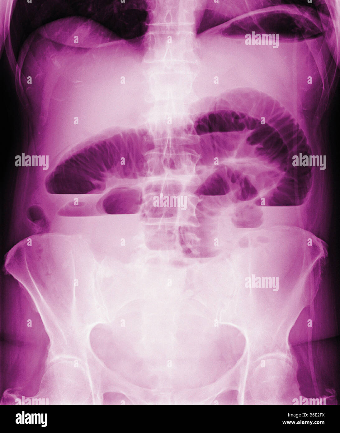 Occluded intestine. Coloured frontal X-ray of ablocked intestine (upper ...