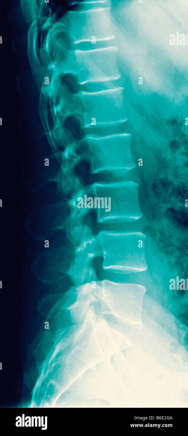 X ray normal lumbar spine hi-res stock photography and images - Alamy