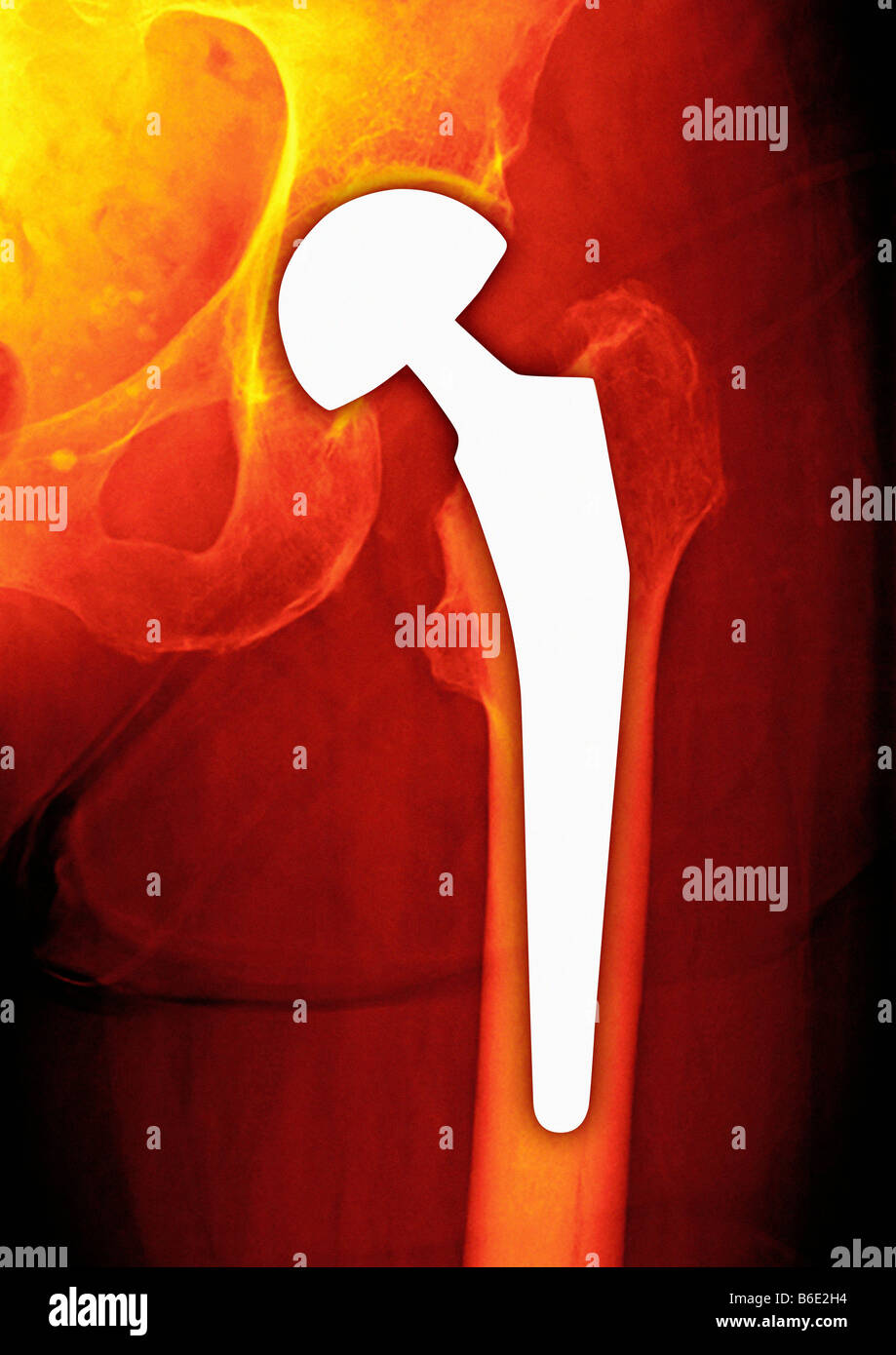 Total hip replacement. Coloured frontal X-ray of a female pelvis with a ...