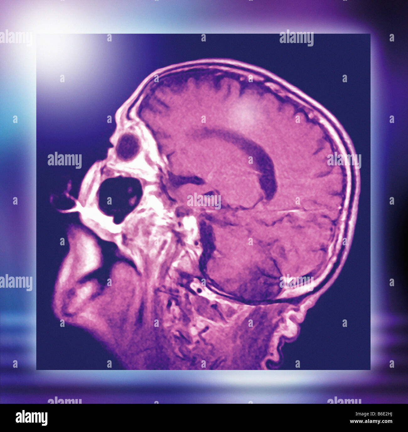 Normal head and brain, coloured profile (sagittal)magnetic resonance imaging (MRI) scan Stock ...