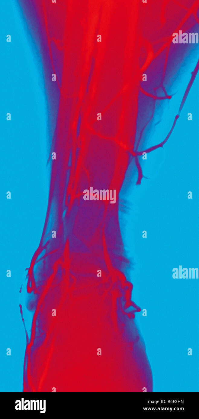 Normal leg veins, coloured angiogram (blood vesselX-ray Stock Photo - Alamy