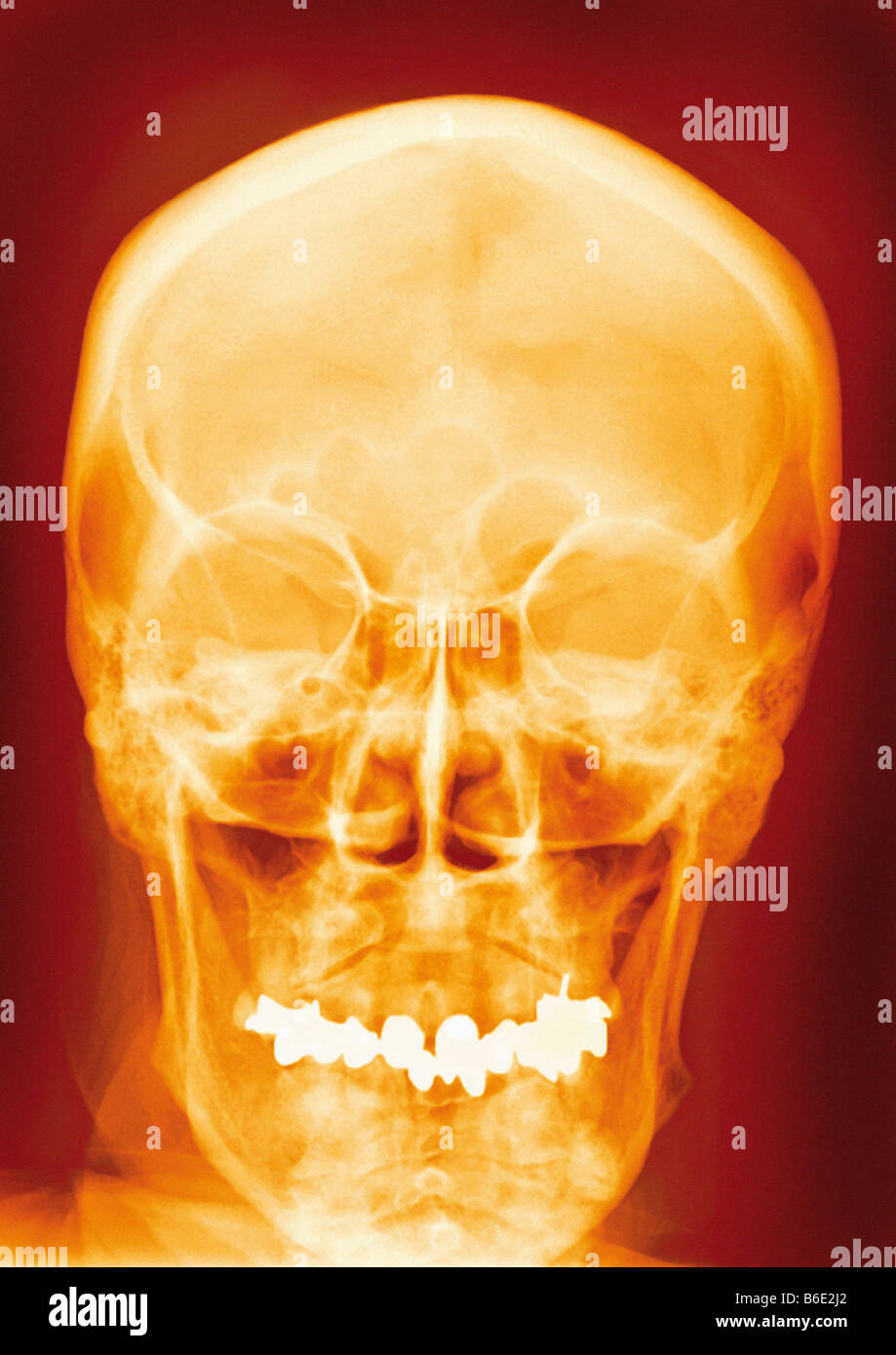 Normal Frontal Skull Xray