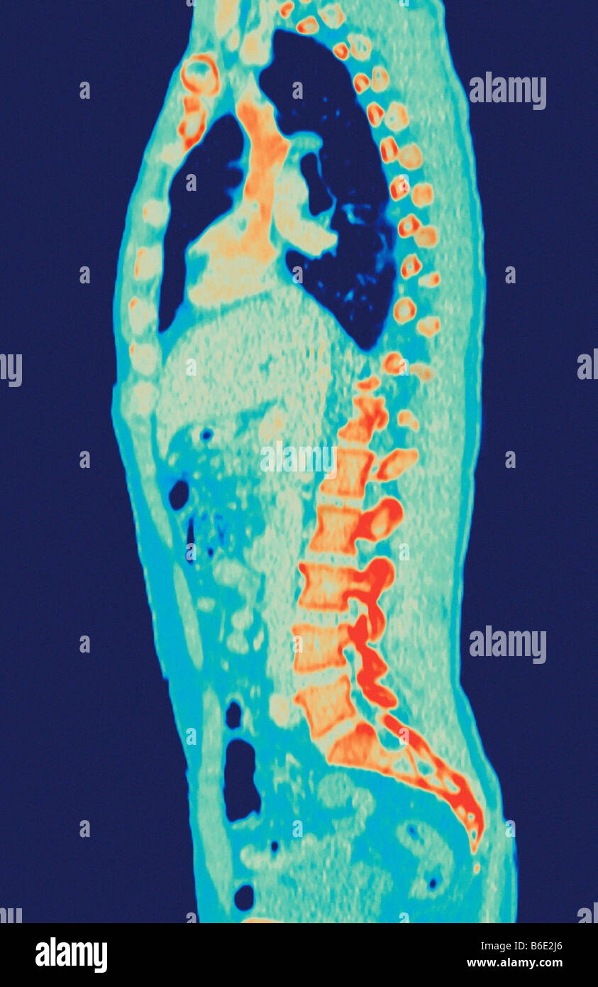 Normal torso, coloured profile (sagittal) magneticresonance imaging ...