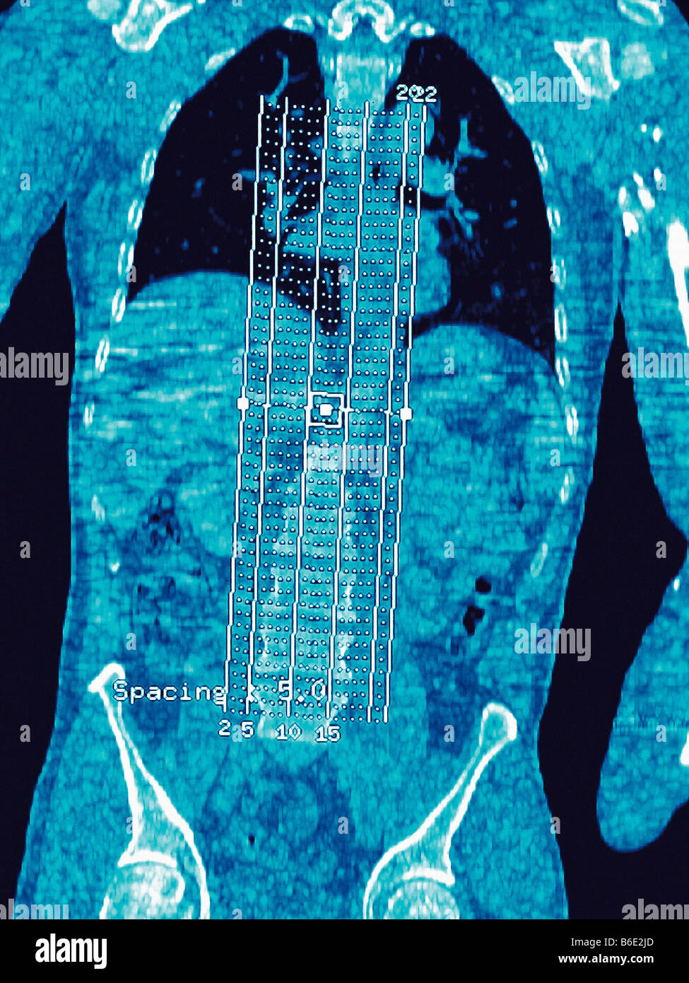 Normal torso, coloured frontal computed tomography(CT) scan Stock Photo ...