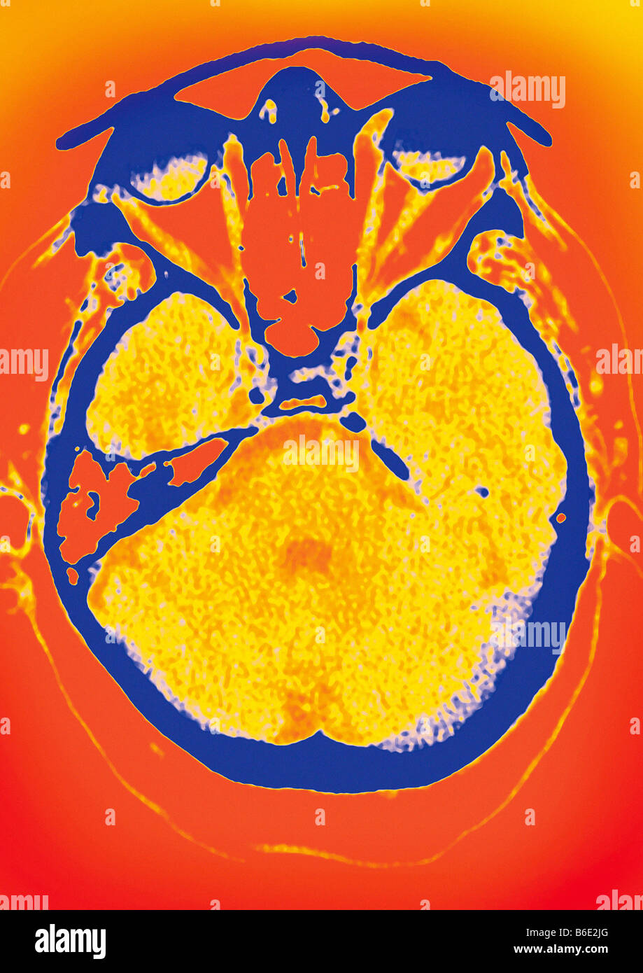 Normal brain, coloured axial (cross-sectional) computed tomography (CT) scan Stock Photo - Alamy