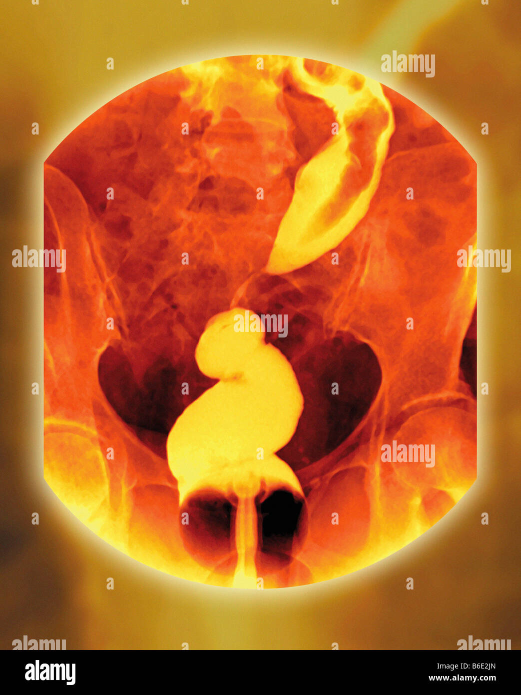 Rectal cancer, coloured frontal X-ray. A malignant (cancerous) tumour ...