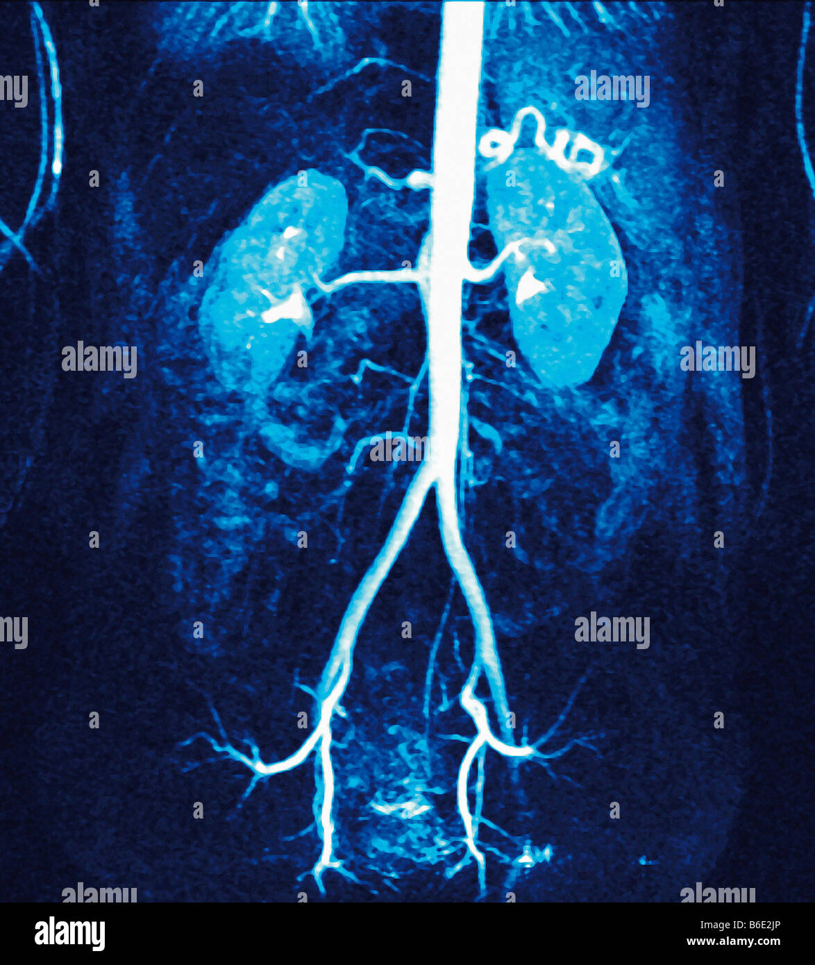 Normal renal arteries. Coloured magnetic resonanceangiogram (MRA) of ...