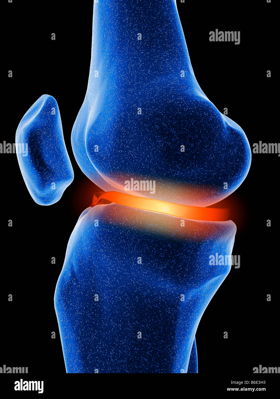 Torn meniscus hi-res stock photography and images - Alamy