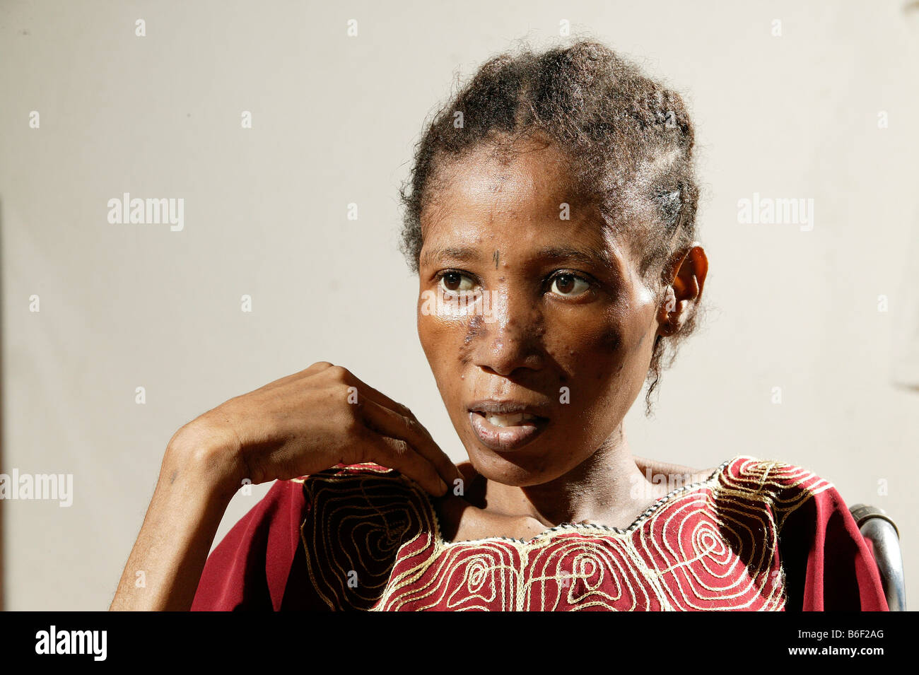 HIV/AIDS infected woman, portrait, hospital, Manyemen, Cameroon, Africa ...
