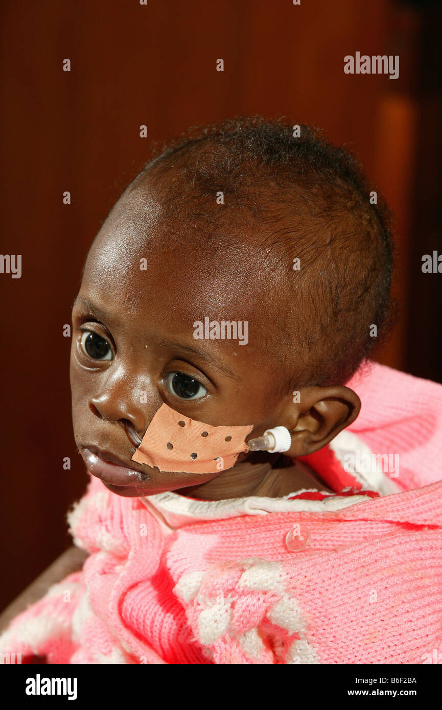 AIDS/HIV infant, portrait, in a hospital in Manyemen, Cameroon, Africa ...