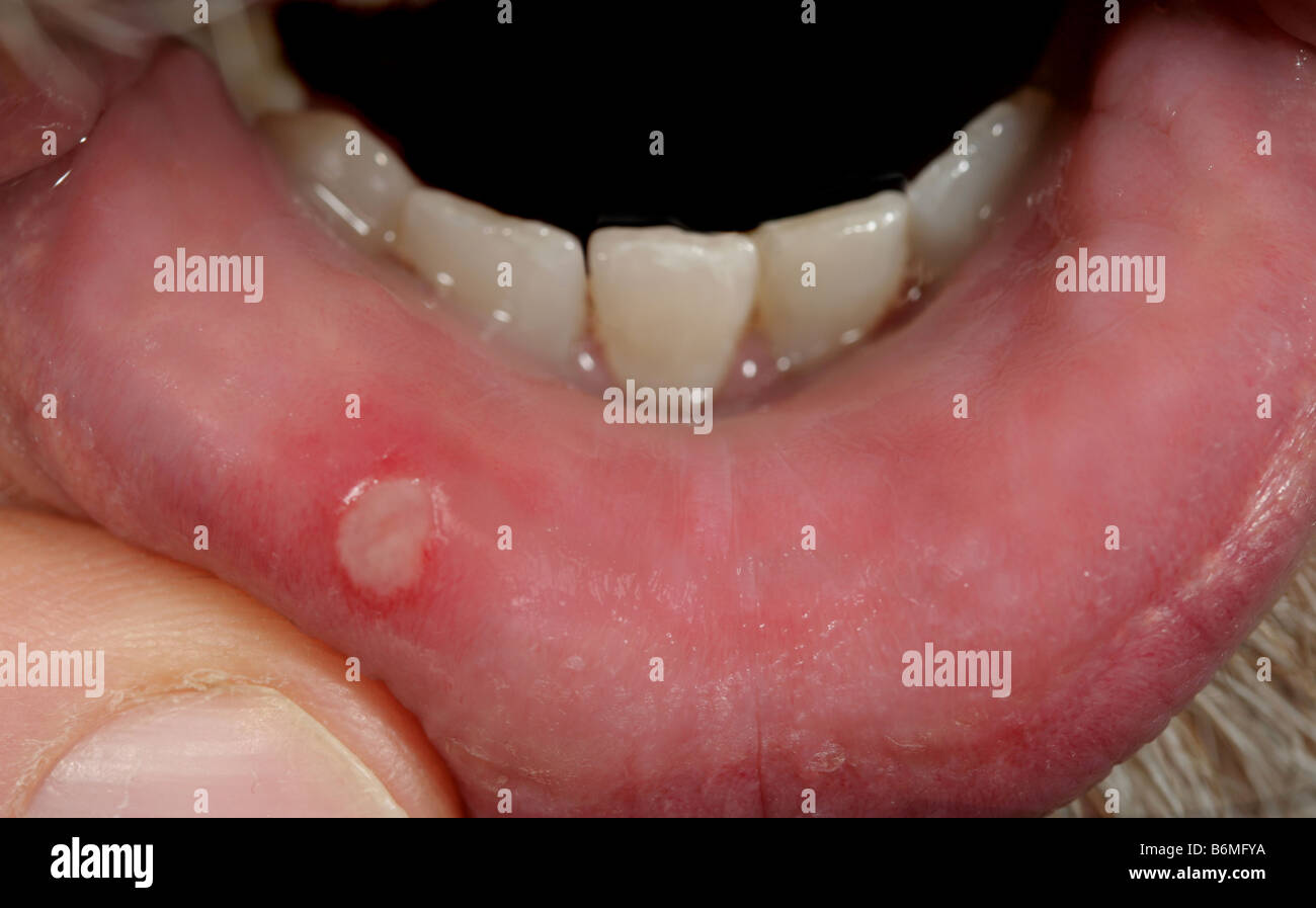 Aphthous Ulcers Canker Sores Bondistry Aphthous Ulcers Canker Sores Bondistry