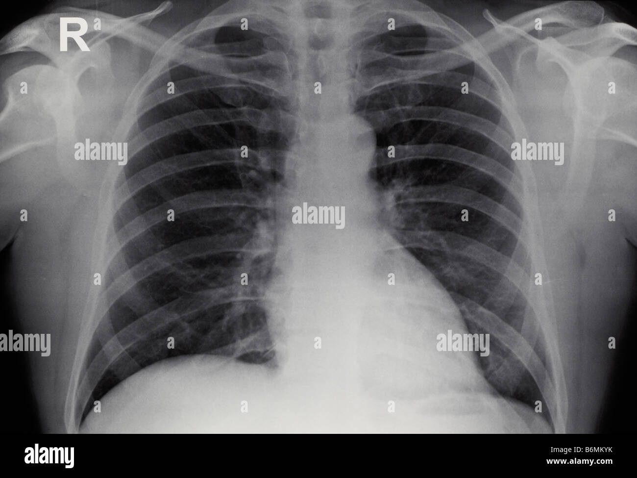 Normal Chest X-Ray Stock Photo - Alamy