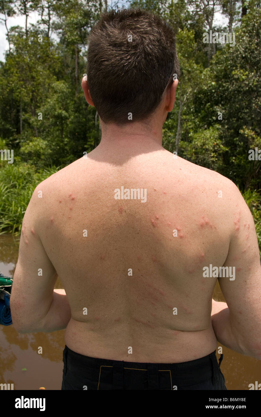 Mosquito Bites On Back
