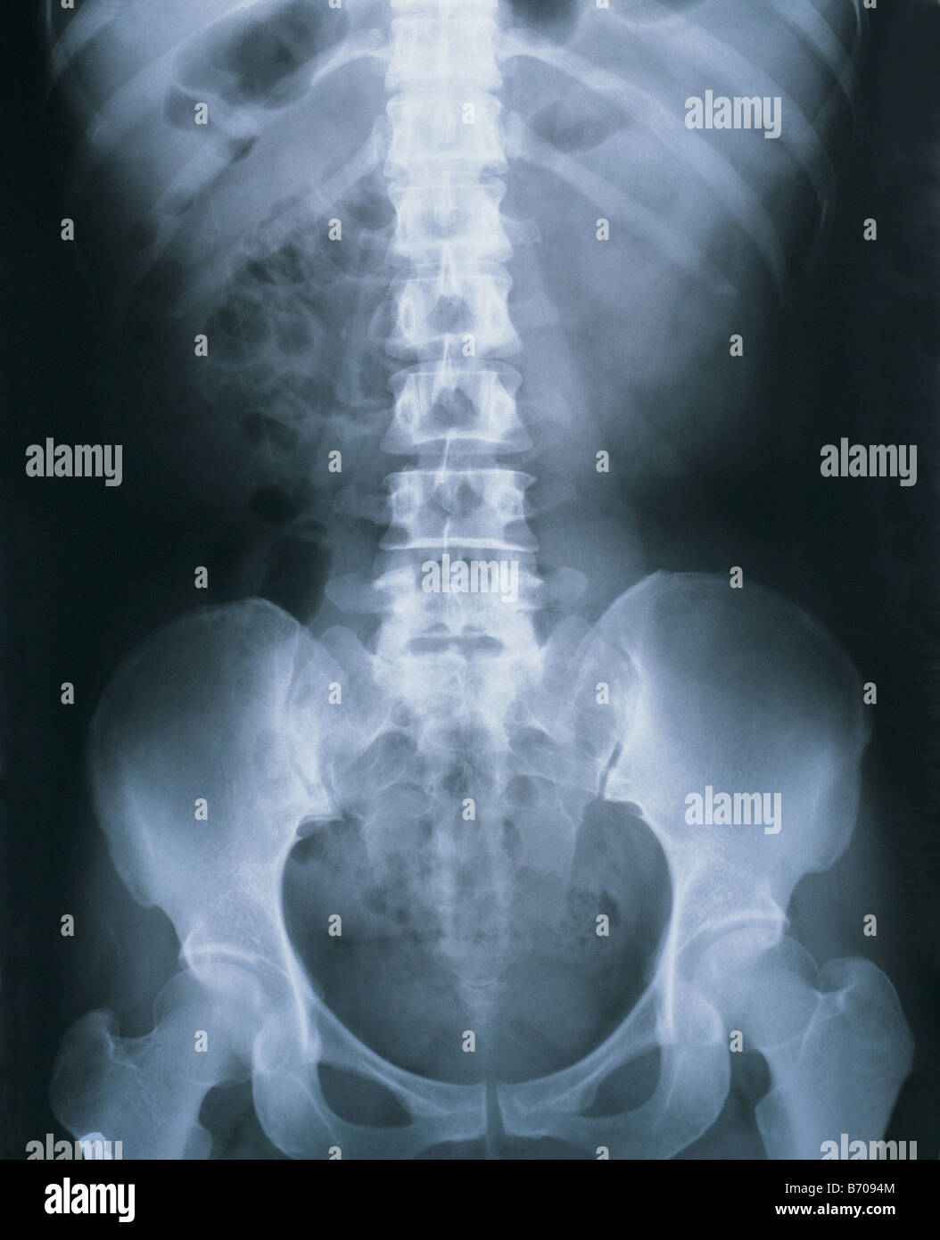 x-ray of bone Stock Photo - Alamy