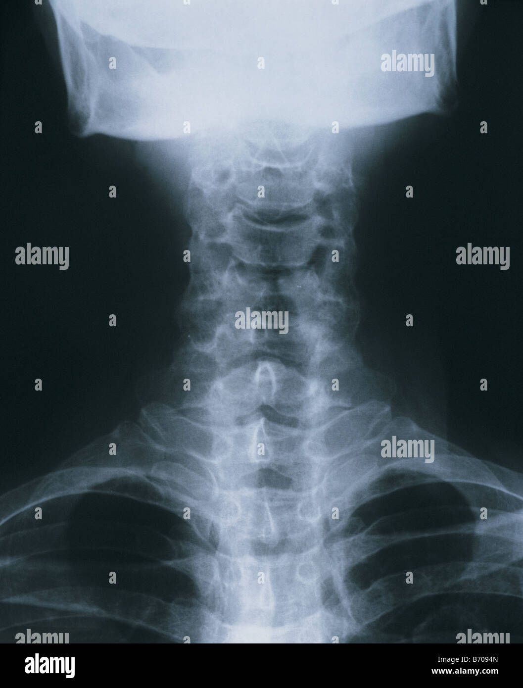 x-ray of bone Stock Photo - Alamy