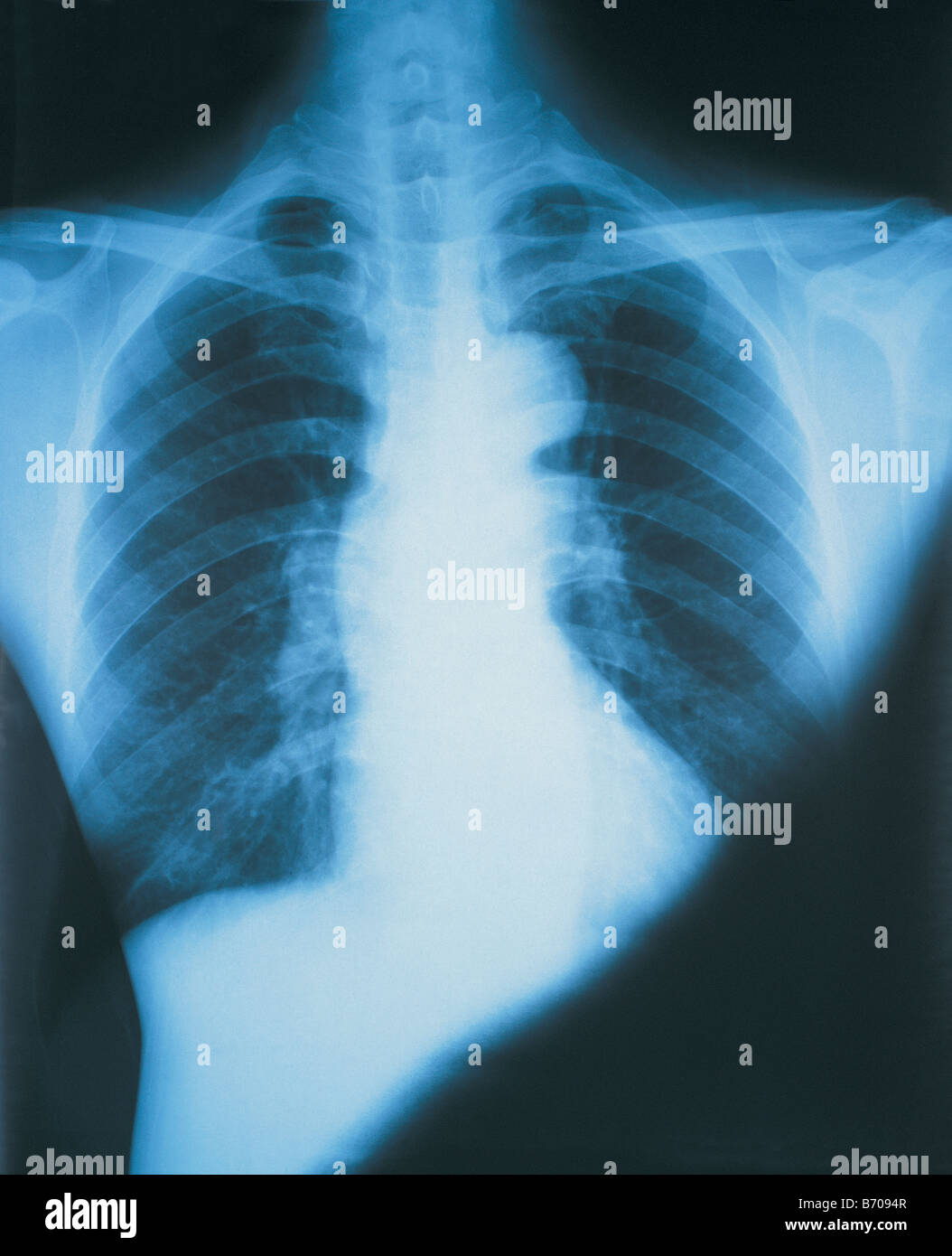 x-ray of bone Stock Photo - Alamy
