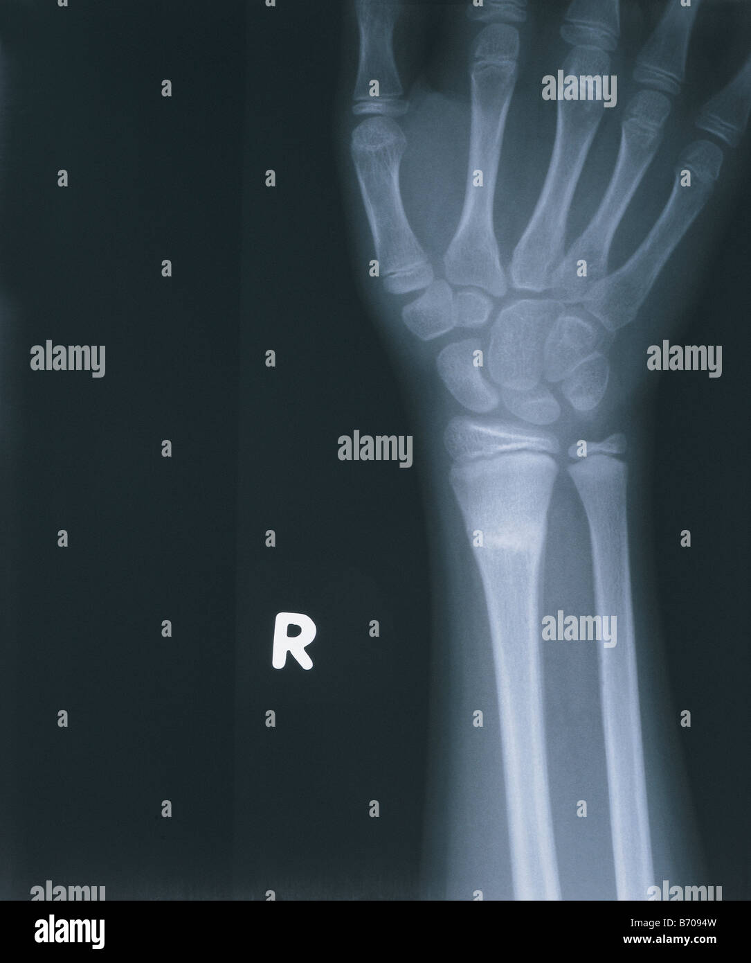 x-ray of bone Stock Photo - Alamy