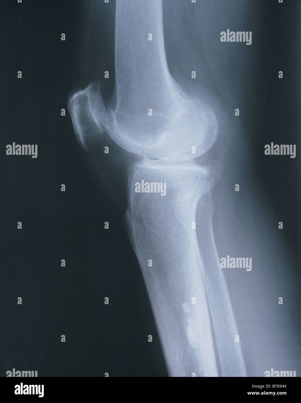 x-ray of bone Stock Photo - Alamy
