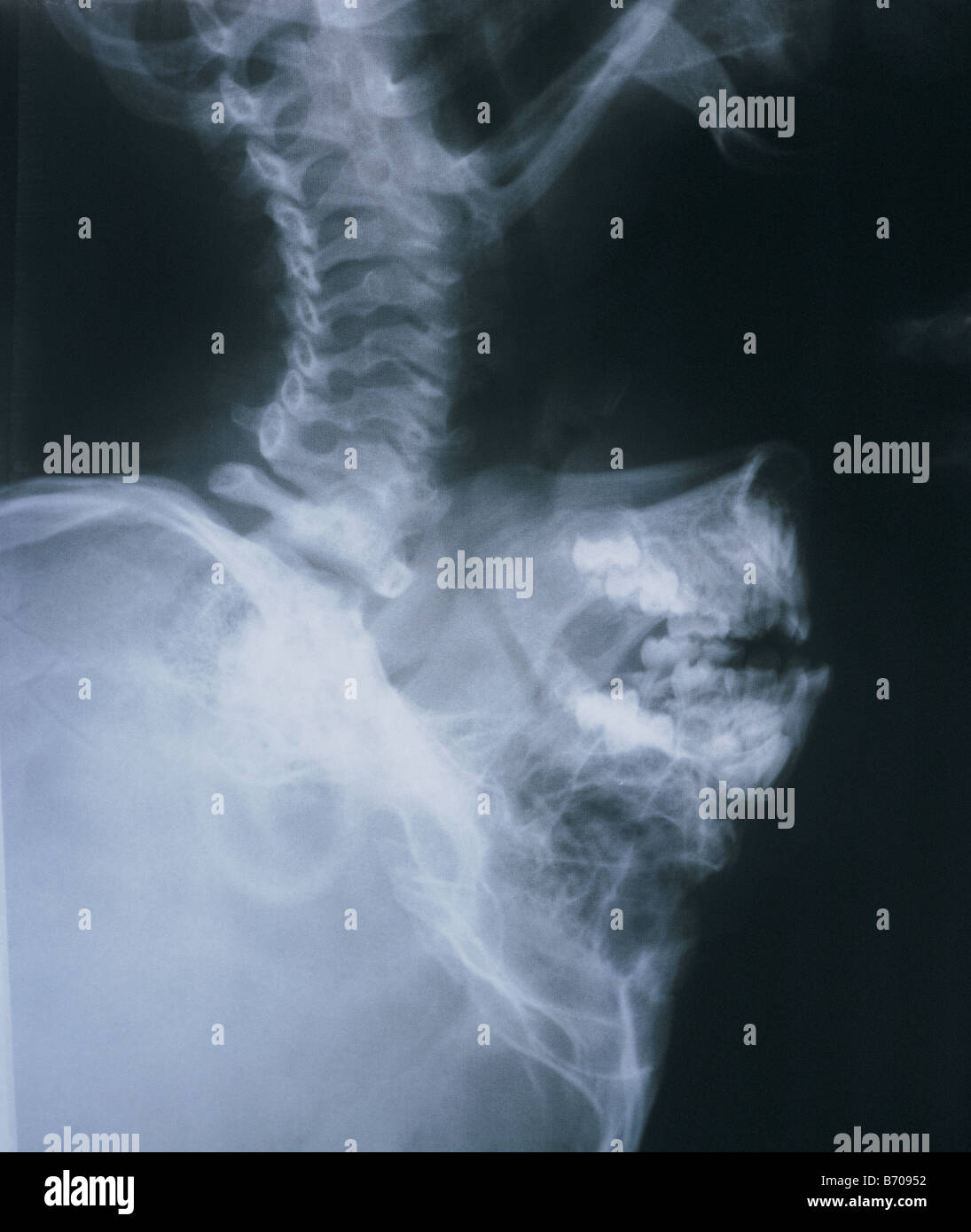 x-ray of bone Stock Photo - Alamy