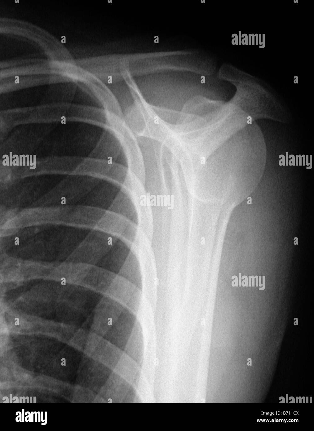 X Ray Normal Shoulder