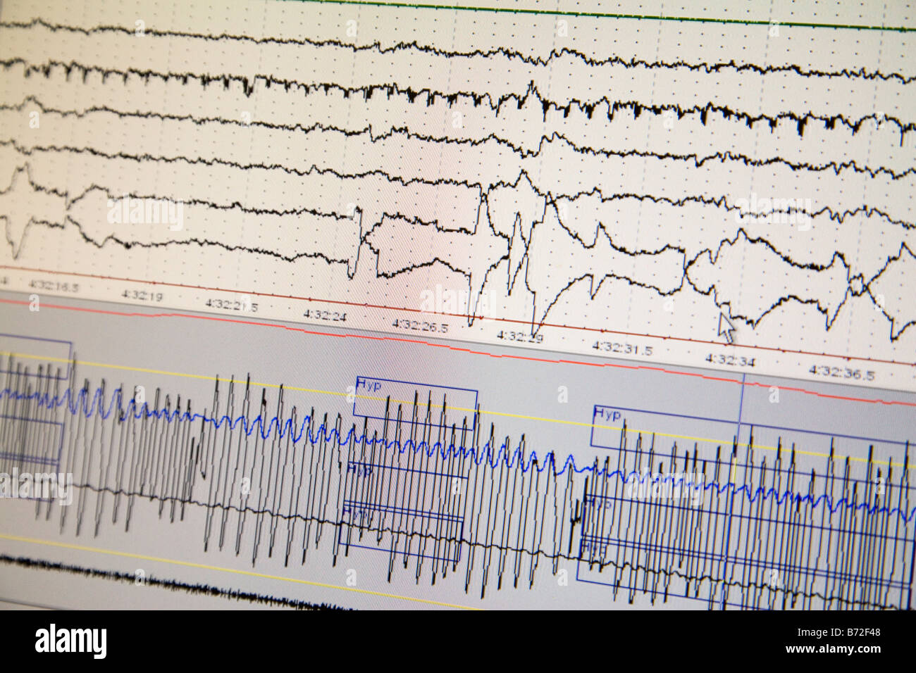 graph of vital signs Stock Photo - Alamy