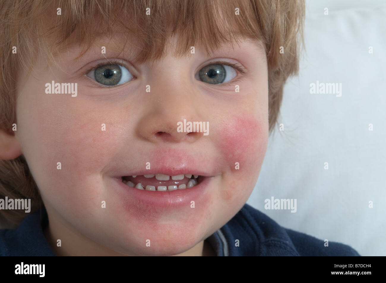 Sickly child hi-res stock photography and images - Alamy