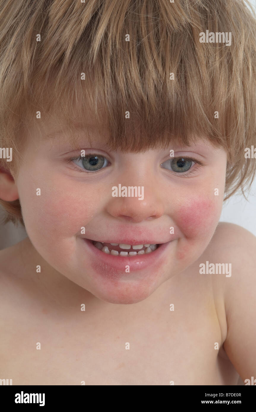 Red cheeks ill hi-res stock photography and images - Alamy