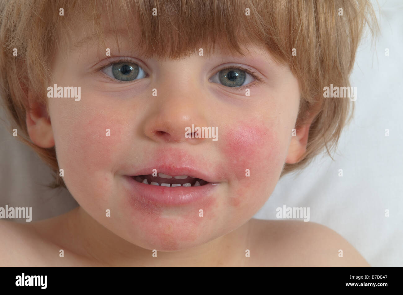 Red cheeks ill child hi-res stock photography and images - Alamy