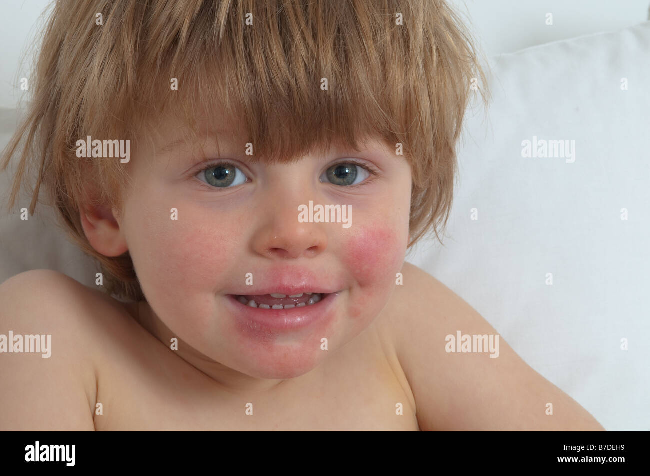 Ill little boy with a very sore face due to a prolonged cold and cough ...