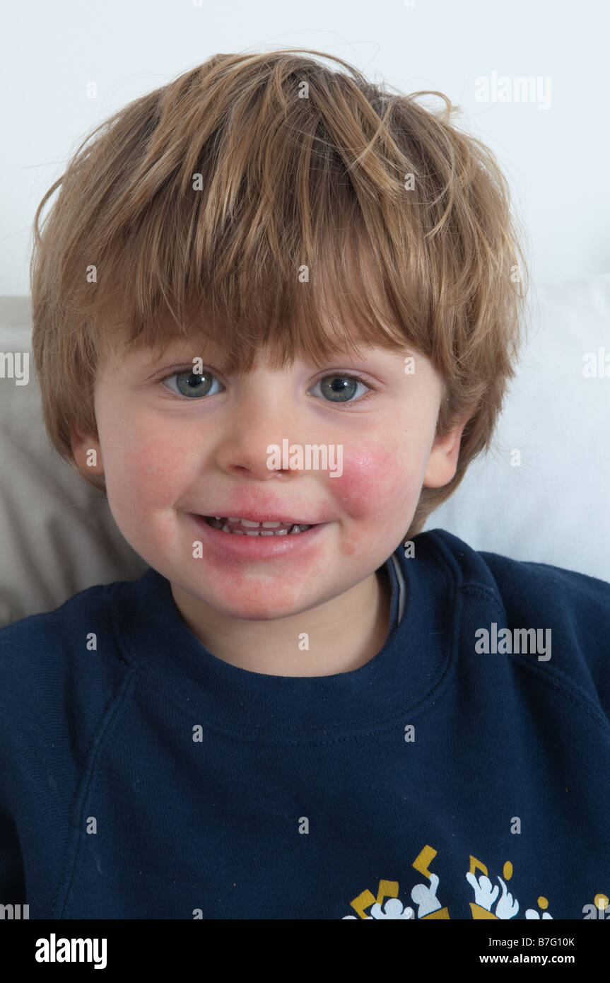 Sores Stock Photos & Sores Stock Images - Alamy
