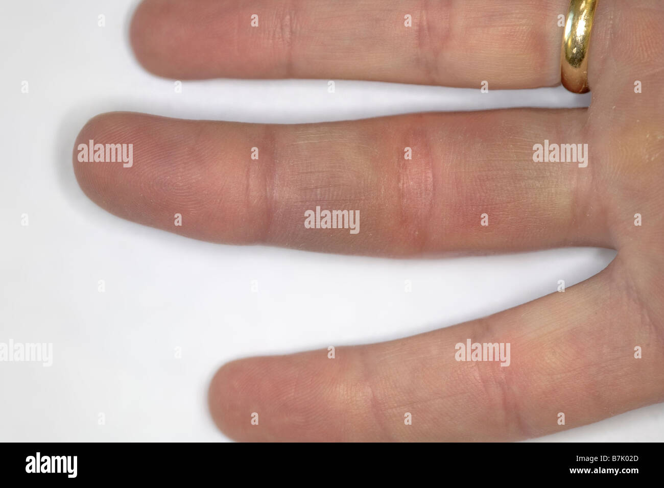 Dislocated finger hi-res stock photography and images - Alamy