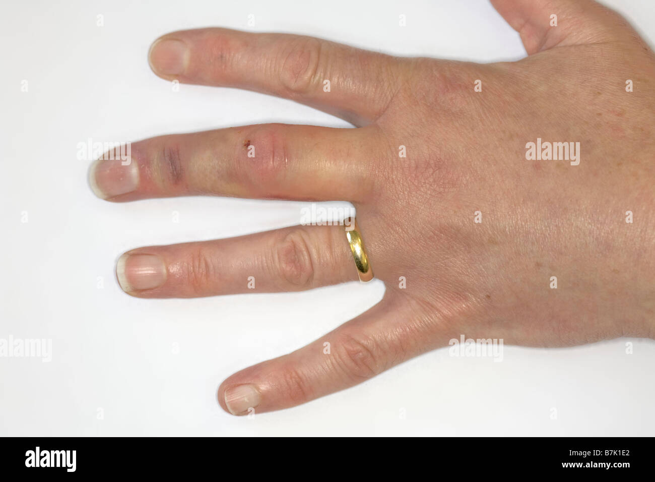 Dislocated Knuckle Dislocated Finger Hi Res Stock Photography And