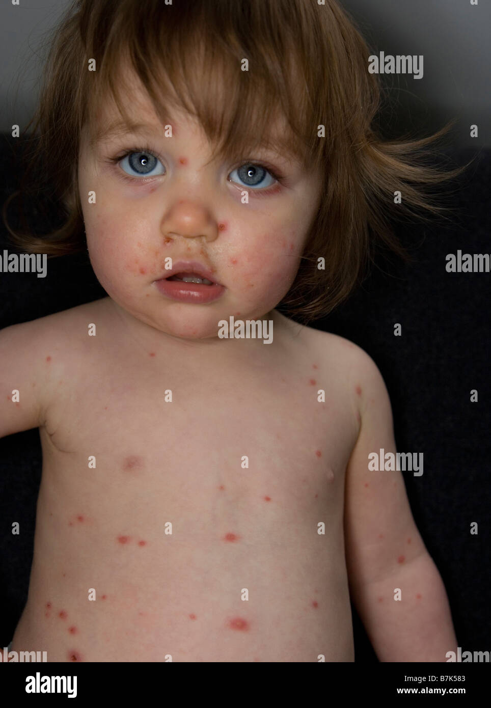 A baby girl with chickenpox Stock Photo - Alamy