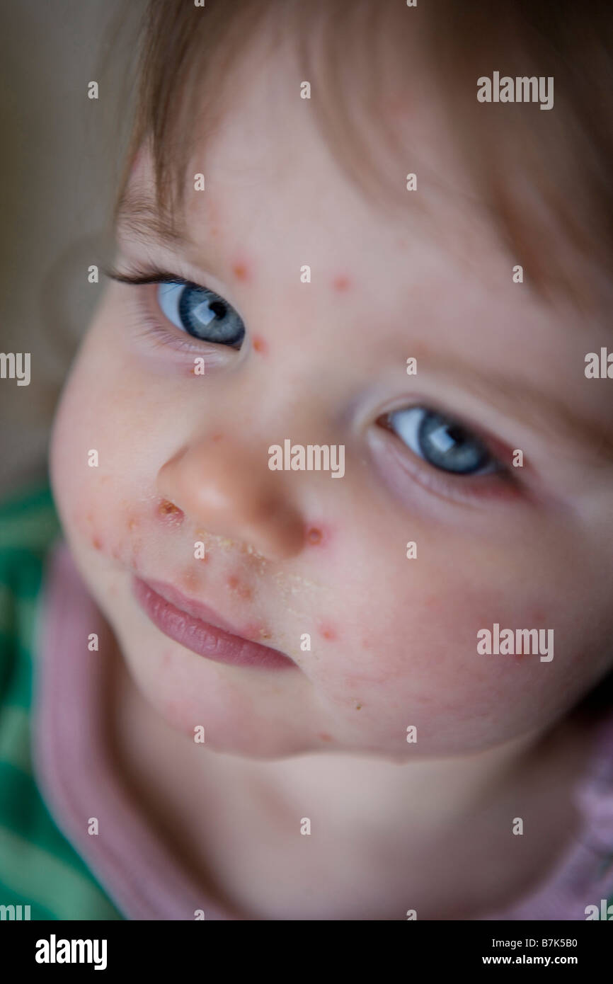 Girl chickenpox spots hi-res stock photography and images - Alamy