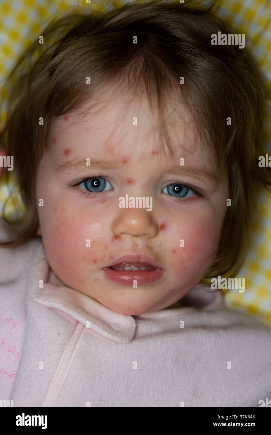 A baby girl with chickenpox Stock Photo - Alamy