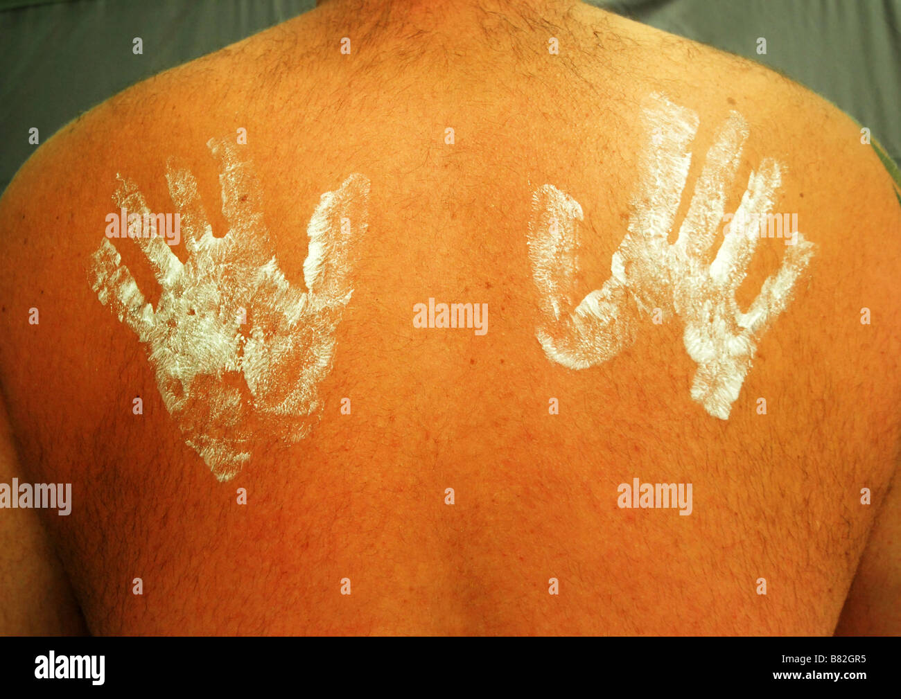 Burn mark skin hi-res stock photography and images - Alamy
