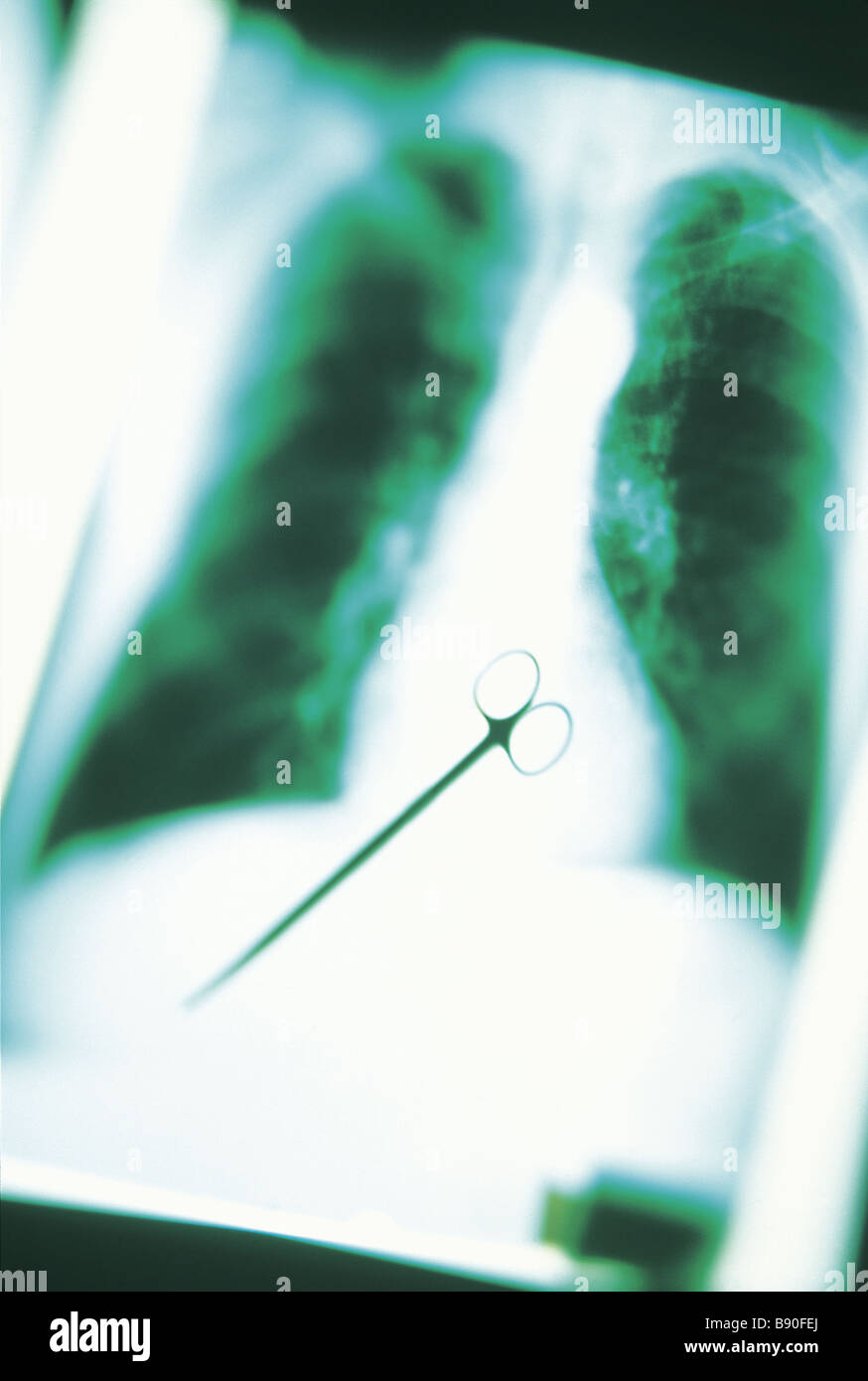 X ray surgical tool left inside hi-res stock photography and images - Alamy