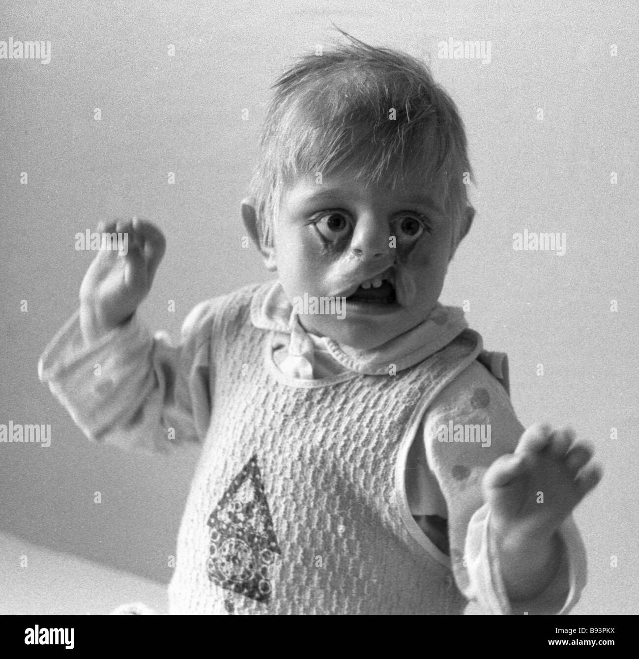 A child with facial defects in the Maxillofacial Surgery Department ...