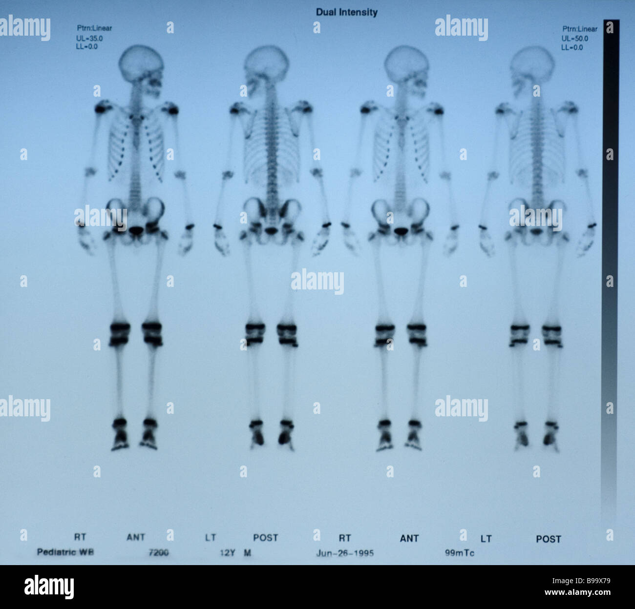 bonescan of a 12 twelve year old normal male Stock Photo - Alamy