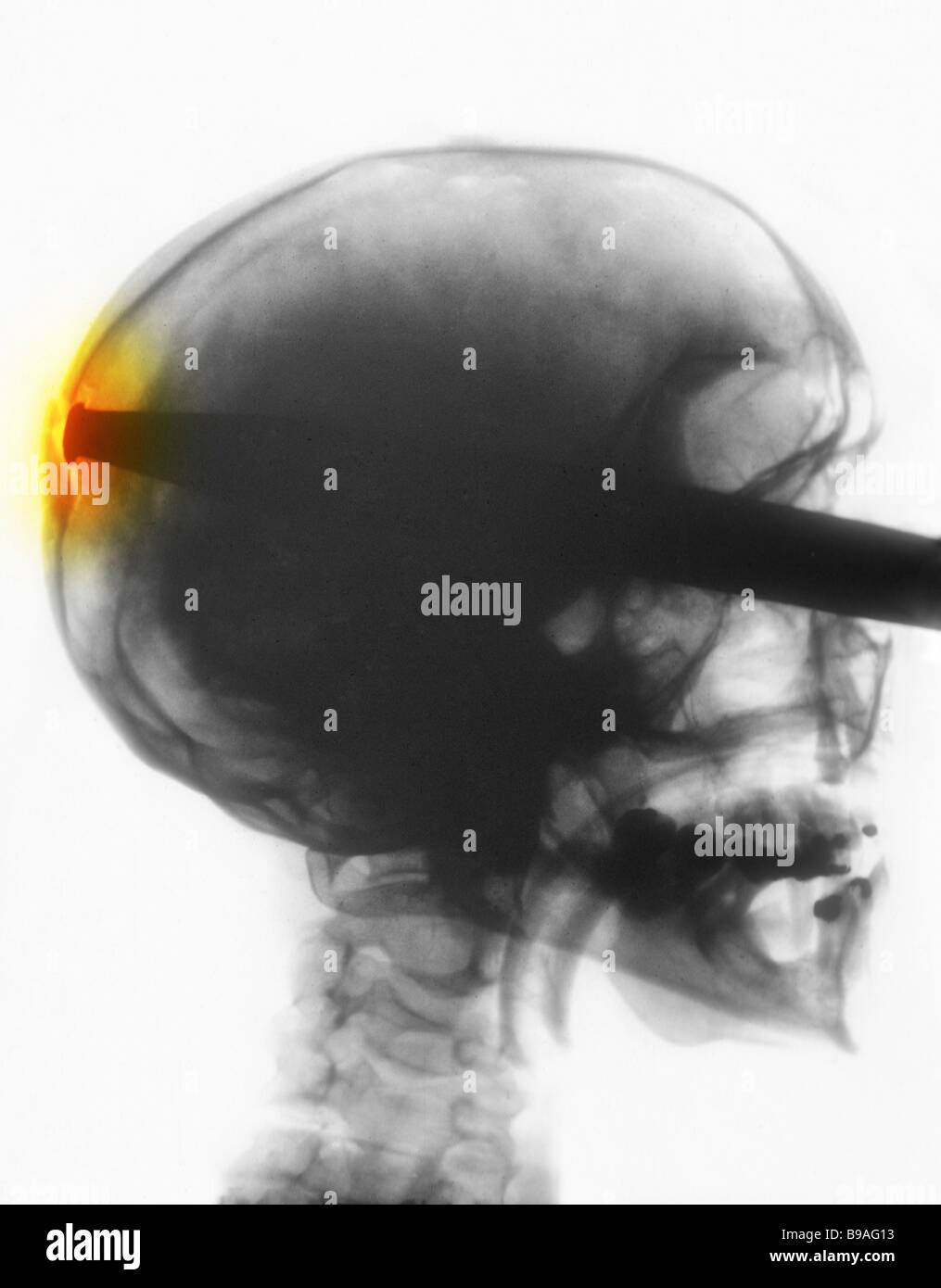 x ray of a skull with a crowbar in it Stock Photo - Alamy